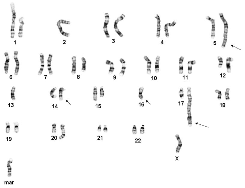 Homogeneously Staining Region (HSR) harboring CMYC amplification in a ...
