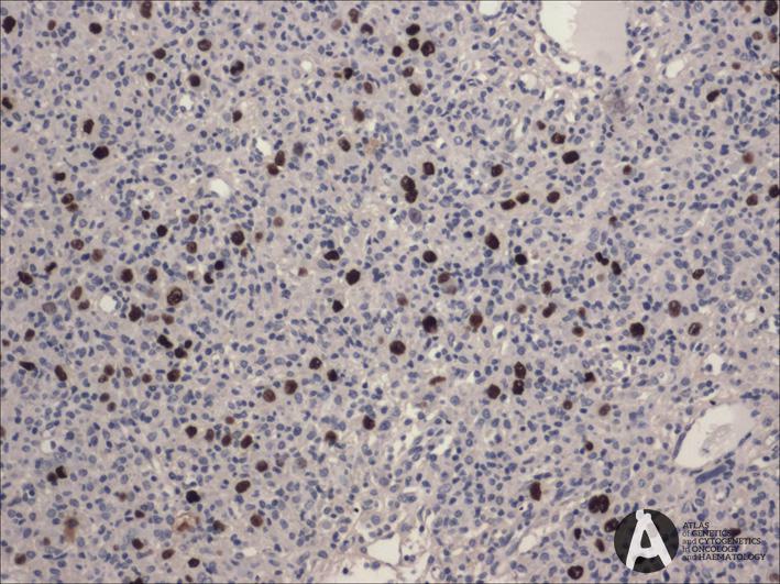 Classical Hodgkin lymphoma type PTLD