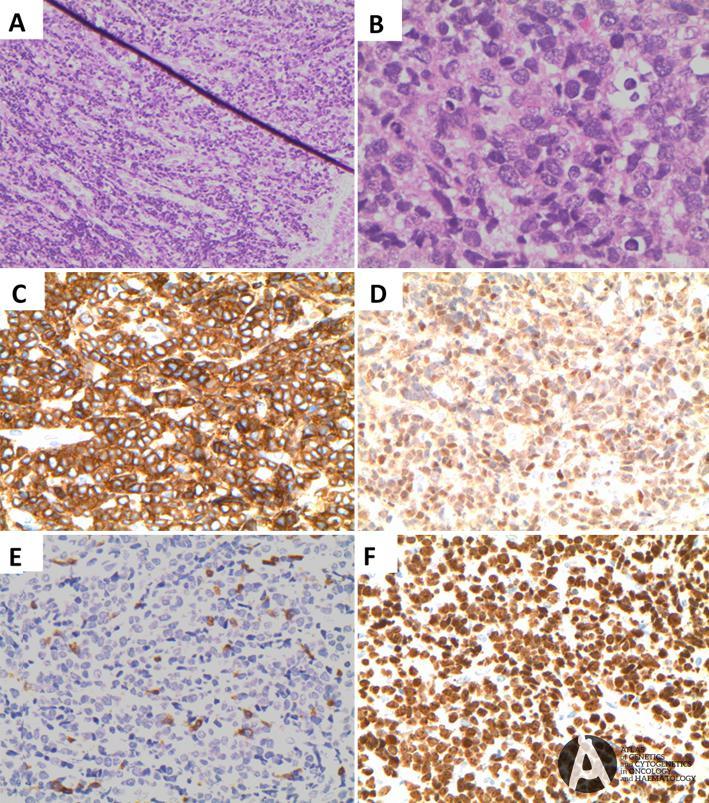 Primary Cutaneous B-Cell Lymphomas