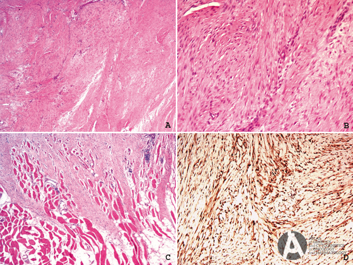 Soft Tissues: Desmoid-type fibromatosis