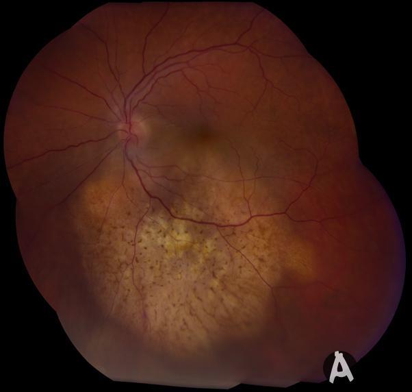 Eye tumors: an overview