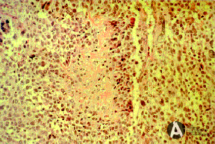 Bone: Osteosarcoma