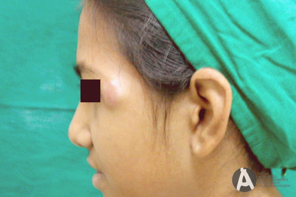 Skin: Pilomatricoma